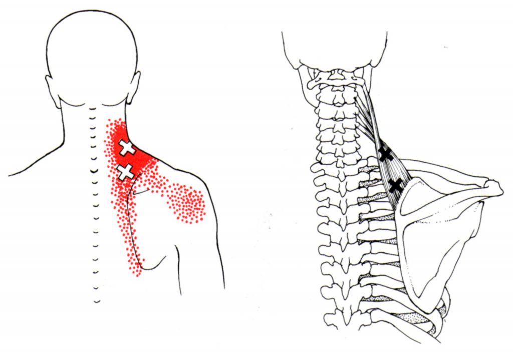 Scapular Dyskinesia: an often neglected cause of Neck Pain | Active ...
